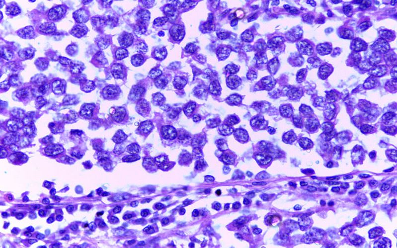 New trial shows half the amount of chemo prevents testicular cancer ...