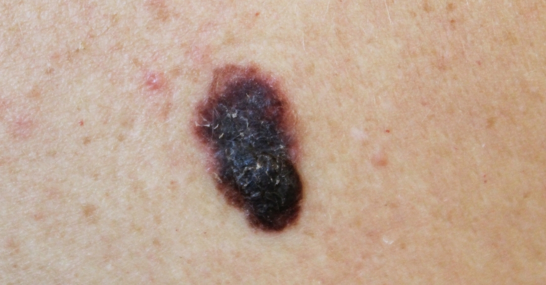 Skin cancer: your guide to spotting melanoma | The Royal Marsden