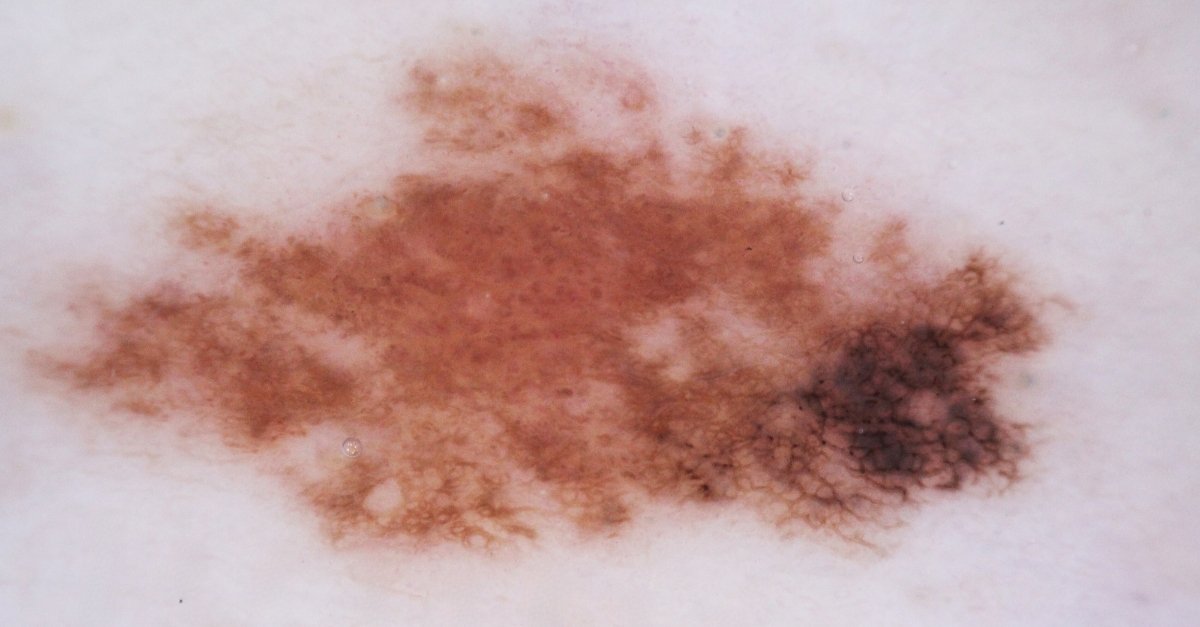 Skin cancer: your guide to spotting melanoma | The Royal Marsden