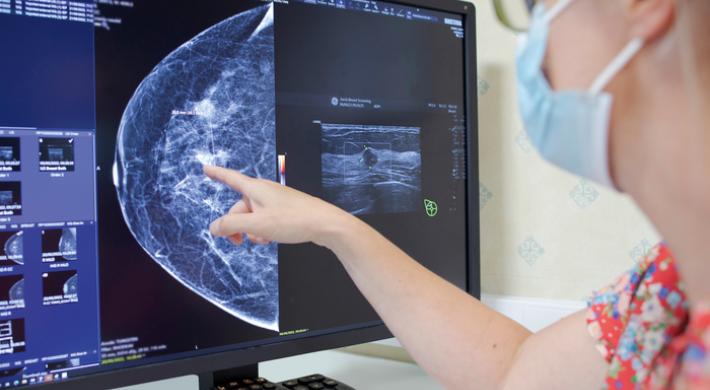 Male breast cancer: Symptoms, diagnosis, and treatment | The Royal Marsden