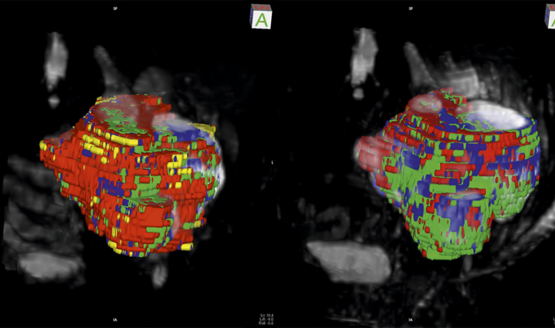 Colour-coding sarcomas | The Royal Marsden